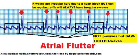 what is the difference between atrial fibrillation a fib and atrial