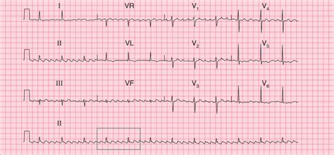 the ecg when the patient has a tachycardia thoracic key