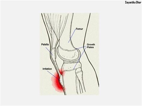 Osgood Schlatter Disease