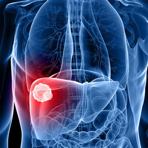 Precision Oncology In Biliary Tract Cancer Are We There Yet 4basecare