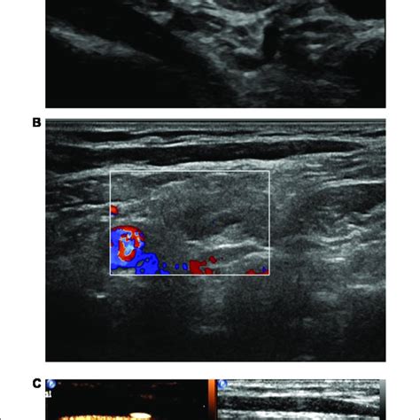 Patient With Left Cervical Tuberculous Lymphadenitis Ctl