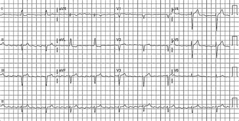 atrioventricular conduction during atrial flutter circulation
