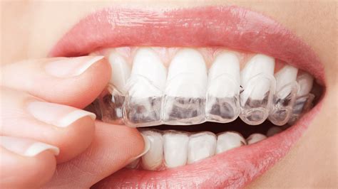 Do Metal Braces Straighten Teeth Faster Than Invisalign® Aligners