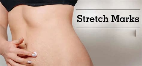 Stretch Mark Removal Skin City India