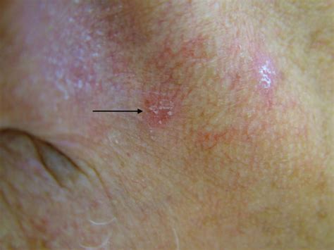Actinic Keratosis Solar Keratosis