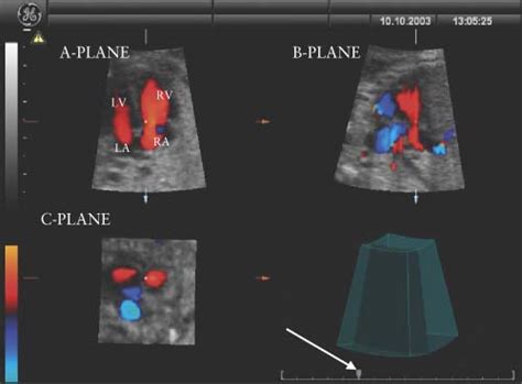 Color Doppler Spatio Temporal Image Correlation Volume Of A 26 Week