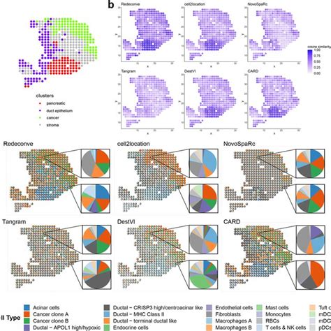 Single Cell Deconvolution Of A Human Pdac Pancreatic Ductal