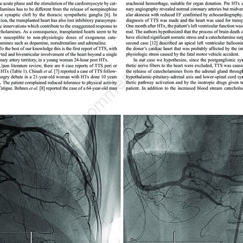 Image result for Normal Coronary CT Angiogram
