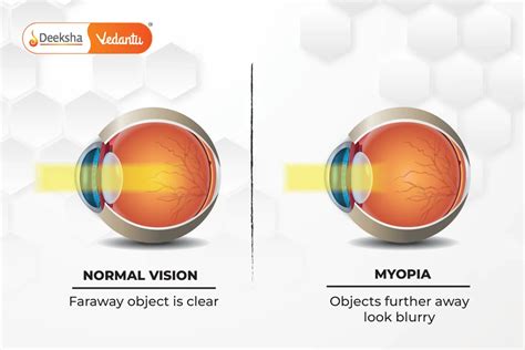 Image result for Vision Defects Myopia
