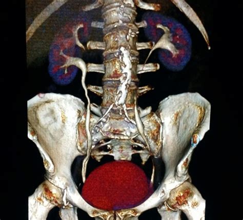 Image result for Urogram 3 Phase CT