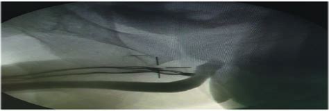 Image result for Urethrogram Technique