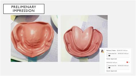 Image result for How to Process a Denture