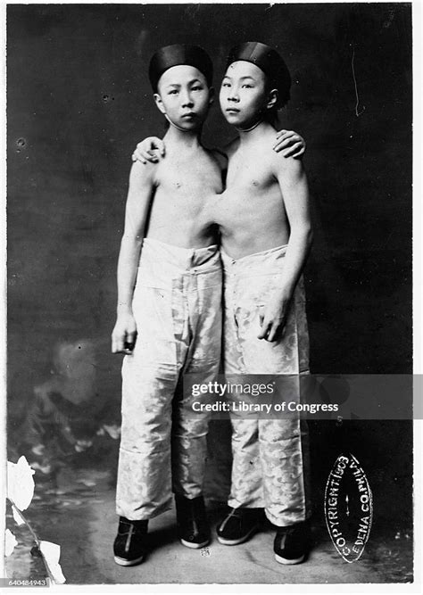 Image result for Java Island Siamese Twins