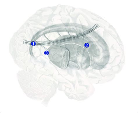 Image result for Contralateral Neglect