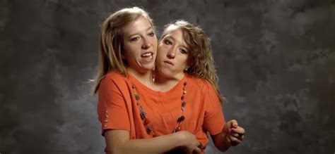 Image result for Java Island Siamese Twins