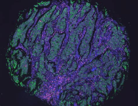 Image result for Multiplex IHC Texture Types Diffuse