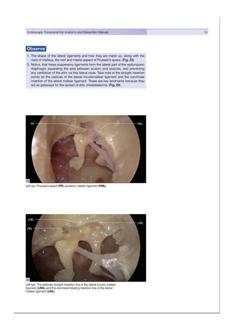 Image result for Ear Dissection