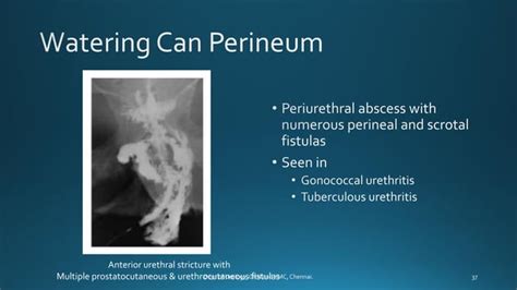 Image result for Acending Urethrogram