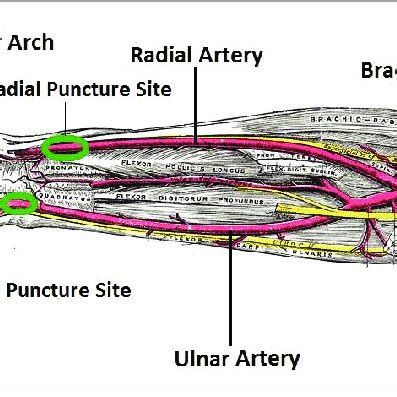 Image result for Radial Loop Angiogram