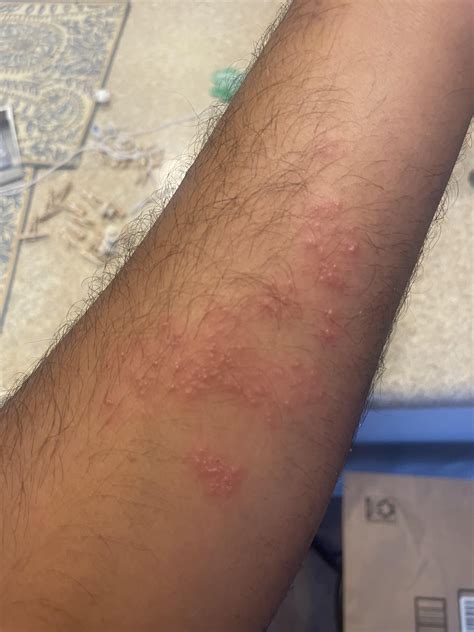 Image result for Shingles On Arm