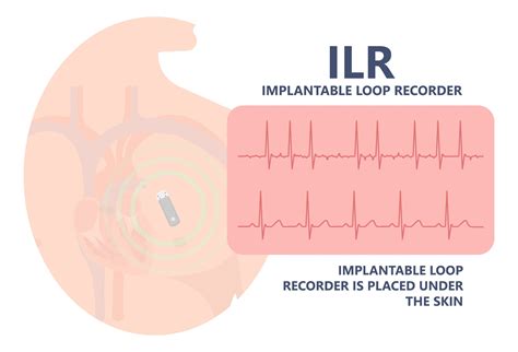 Image result for Loop Recorder Suture