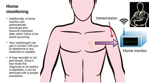 Image result for Loop Recorder Surgery