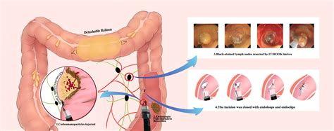 Image result for Colon Open Cancer Removal