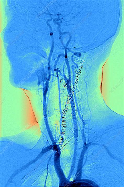 Image result for Heart Block Angiogram