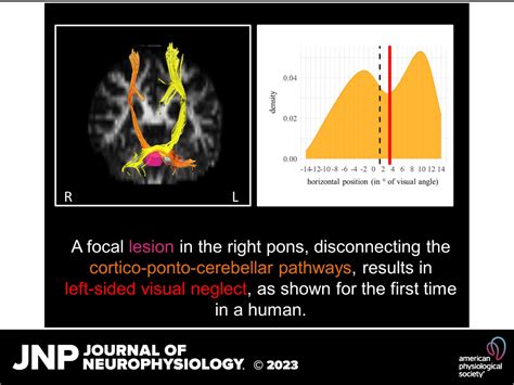 Image result for Contralateral Neglect