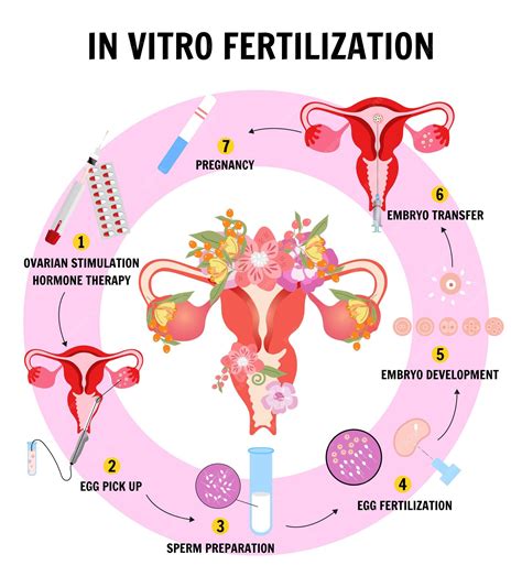 Image result for In Vitro Fertilization Procedure Step by Step