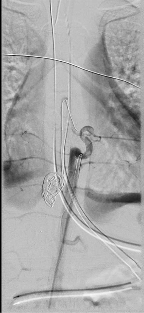 Image result for Spinal Angiogram