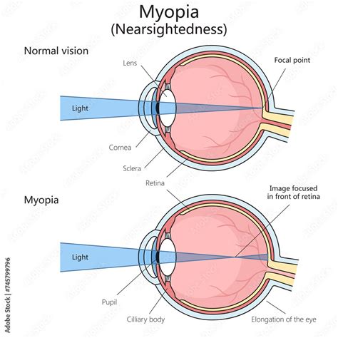 Image result for Vision Defects Myopia