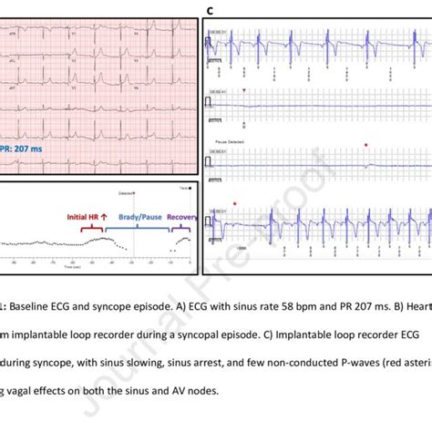 Image result for Loop Recorder Suture