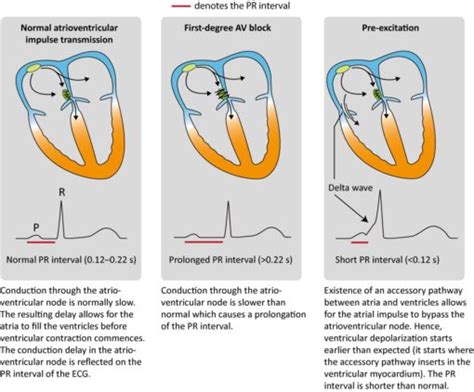 Image result for PR Interval ECG