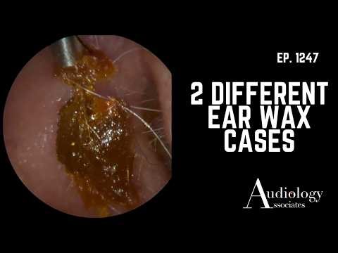 Two Very Different Ear Wax Removals – Deep Compacted Blockage and Soft Plug Cleared - EP1247