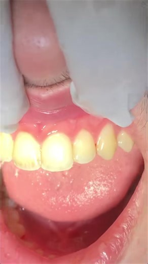 POLISHING might be all you need! 😊 It's perfect for removing stains, and it's: - Gentle on enamel - Quick - Removes plaque - Leaves teeth smooth, so food doesn't stick Great for a quick teeth refresh! 💕 Get better guidance from your dentist!!! #drfaiquaanwar #calculusslayer #dentist #teeth #polishing