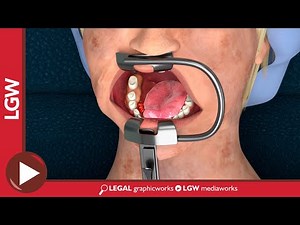 Dental Biopsy 3D Animation