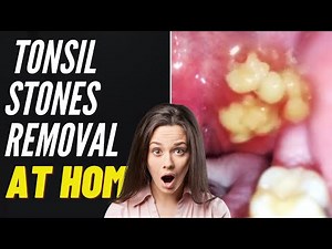 Tonsil Stones Removal At Home