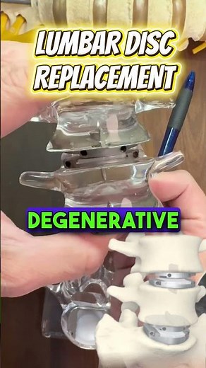 LDR: Lumbar Disc Replacement (Dallas Surgeon Explains)