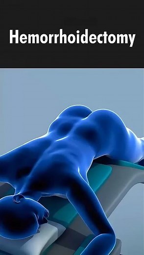 How hemorrhoidectomy is performed: hemorrhoid surgery 3d animation #piles #hemorrhoid