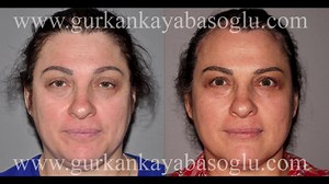 Upper and Lower Blepharoplasty Before and After