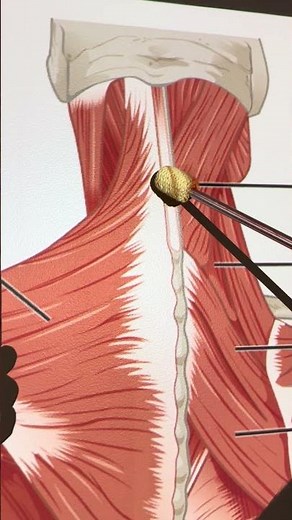 Splenius Capitis #kinesiology #anatomy #anatomystudy #science #biomechanics #biology