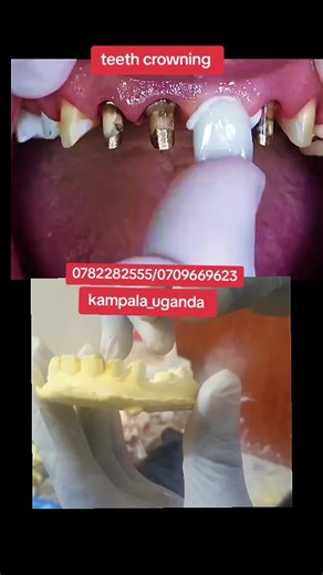 Restore Your Smiles with Teeth Crowning in Kampala