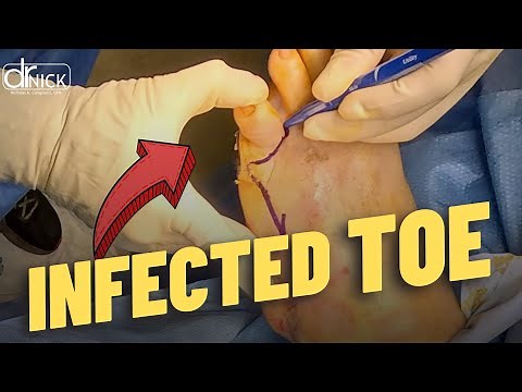 Removing a “Pinky Toe” - Partial 5th Ray Amputation