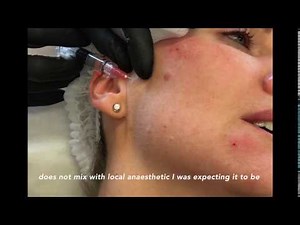 Profhilo at Clinetix