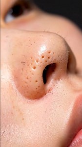 Blackhead Vacuum: Does It Really Work? 🔥