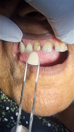 #broken front tooth#front tooth cap/crown #dentist#🦷🦷🪥🪥