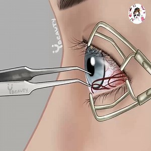 4M views · 14K reactions | ASMR Popping Eye Tapeworm & Eyelash Lice Removal | Te mar 34 | Facebook