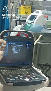 cvp procedure ultrasound guided step by step #emergencymedicine #ultrasound #cvp #pocuseducation
