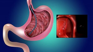Gastric Mucosa. Digestive Endoscopy or Gastroscopy. Performing a Gastroscopy Procedure Stock Video - Video of digestive, gastric: 331880267